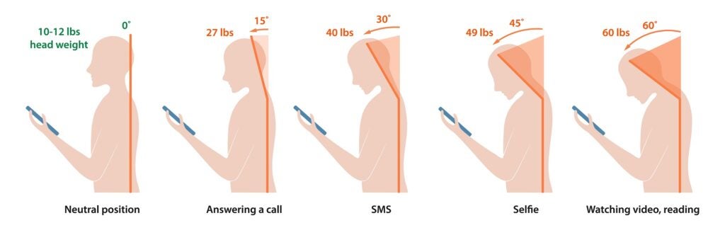 What Is 'Tech Neck'? Explainer and Exercises to Relieve Pain